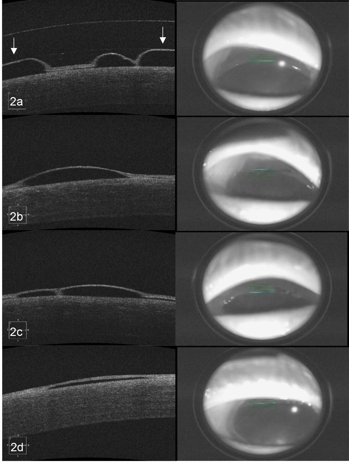 Case Series Transient Corneal Subepithelial Macrocysts With Scleral
