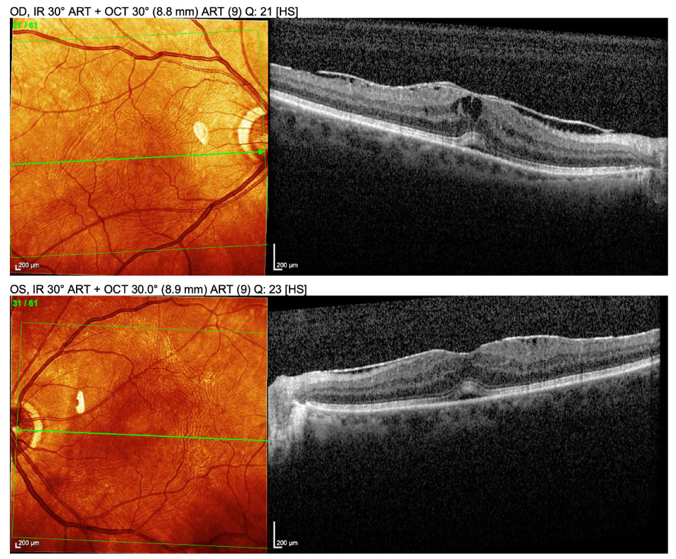 How Long Does Macular Edema Last After Cataract Surgery Infoupdate How Long Does Macular Edema Last After Cataract Surgery Infoupdate
